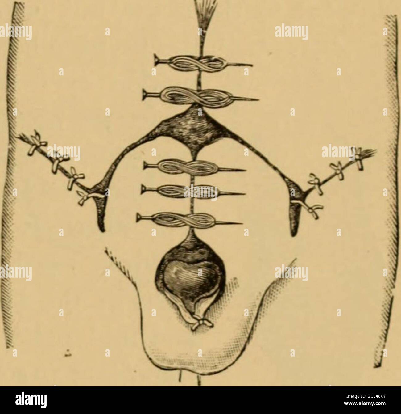 . A system of obstetrics . Woods Operation for Extroverted Bladder ...