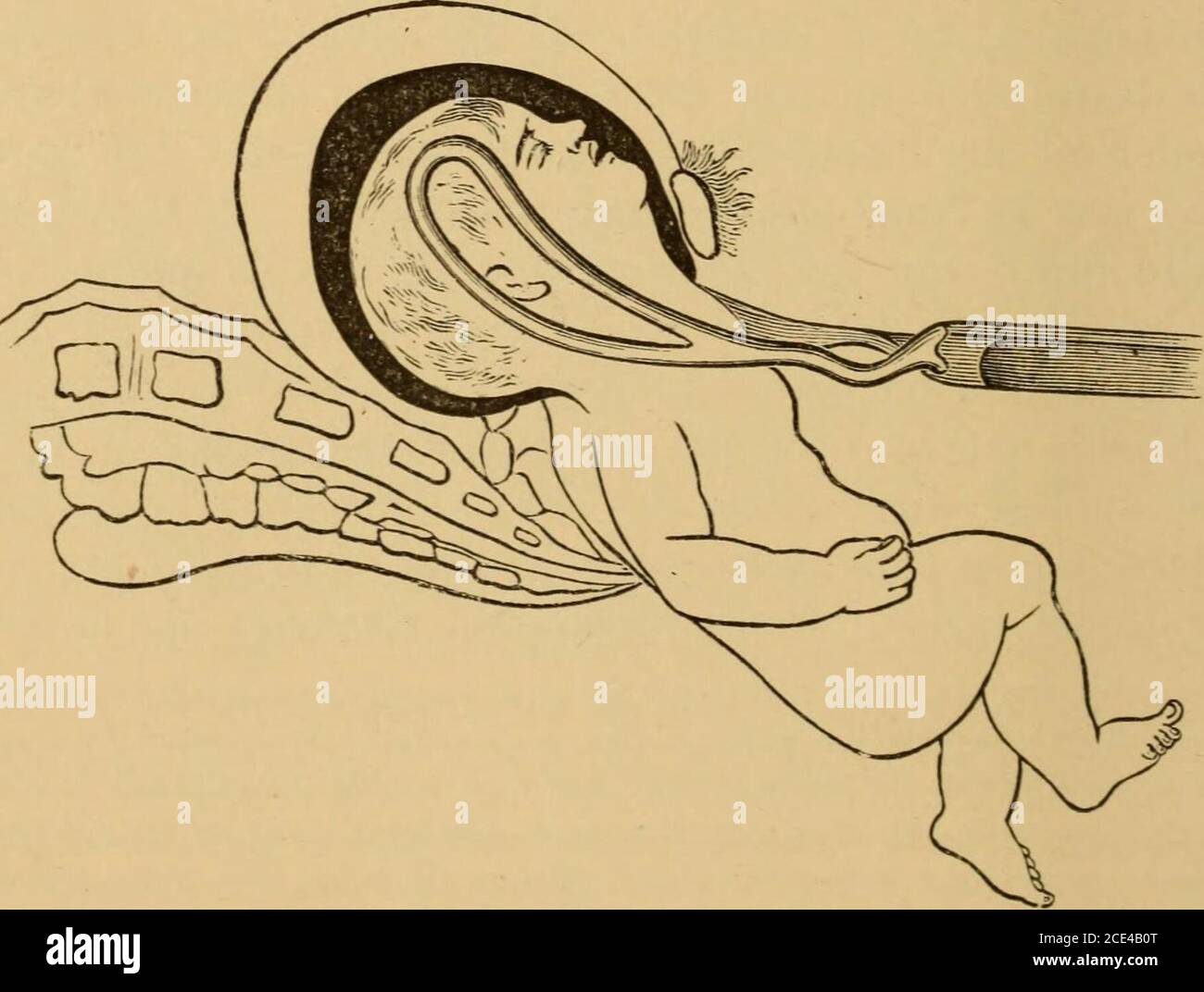 . A system of obstetrics . Forceps Delivery of the After-coming Head in ...