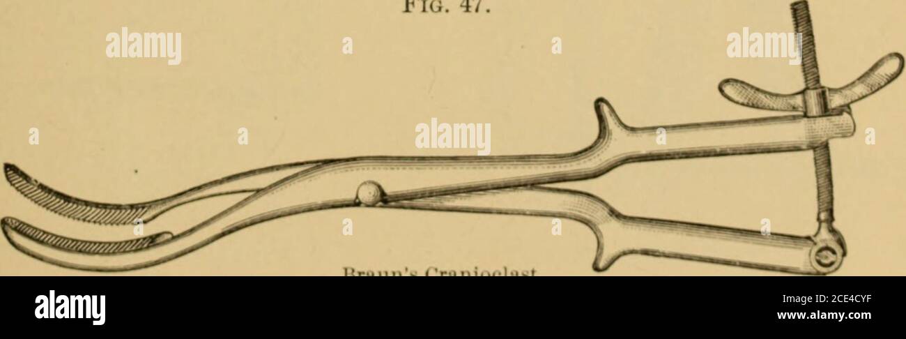 . A system of obstetrics . Simpsons »Tranioclast foration. This ...