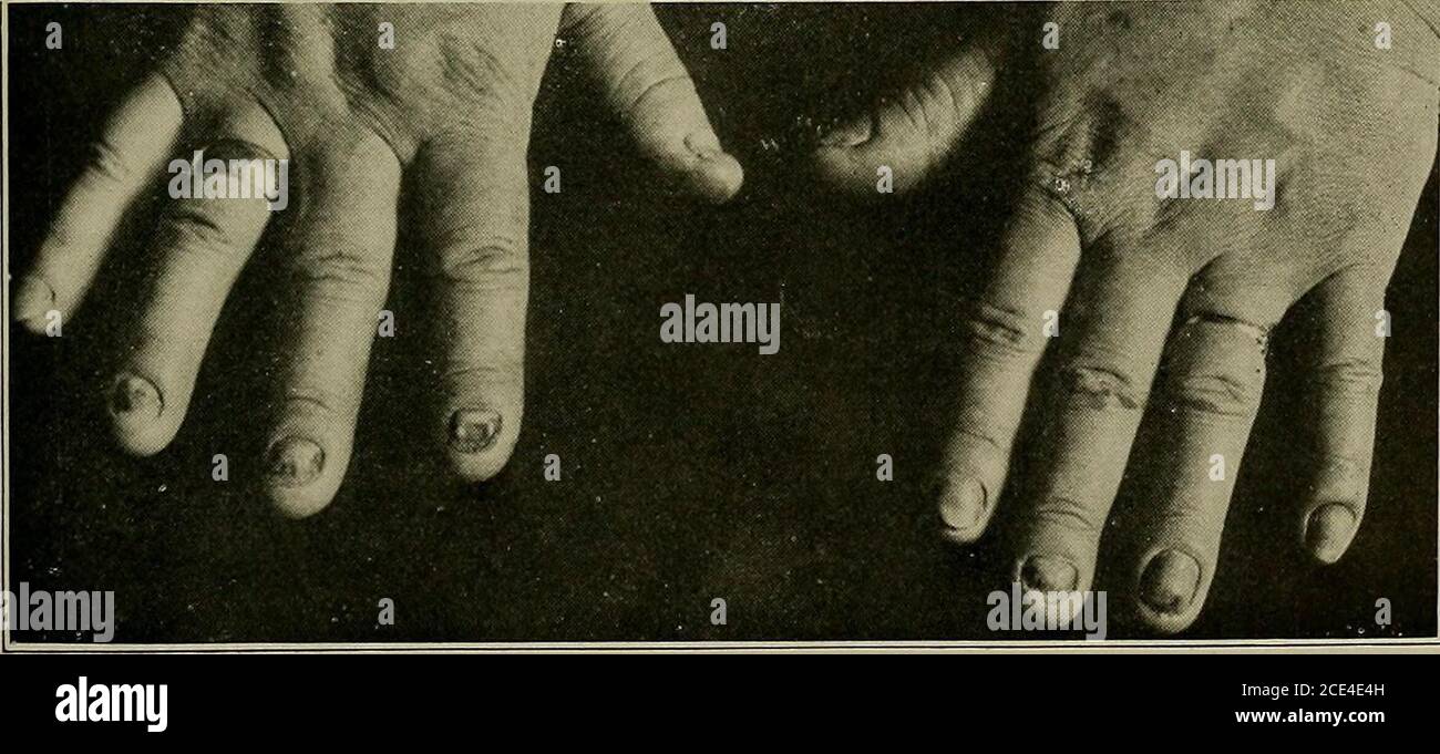 . Syphilis : a treatise on etiology, pathology, diagnosis, prognosis ...