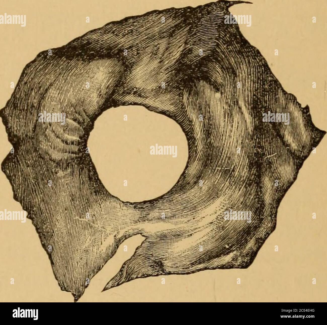 . A system of obstetrics . a was employed, and then a tampon was ...