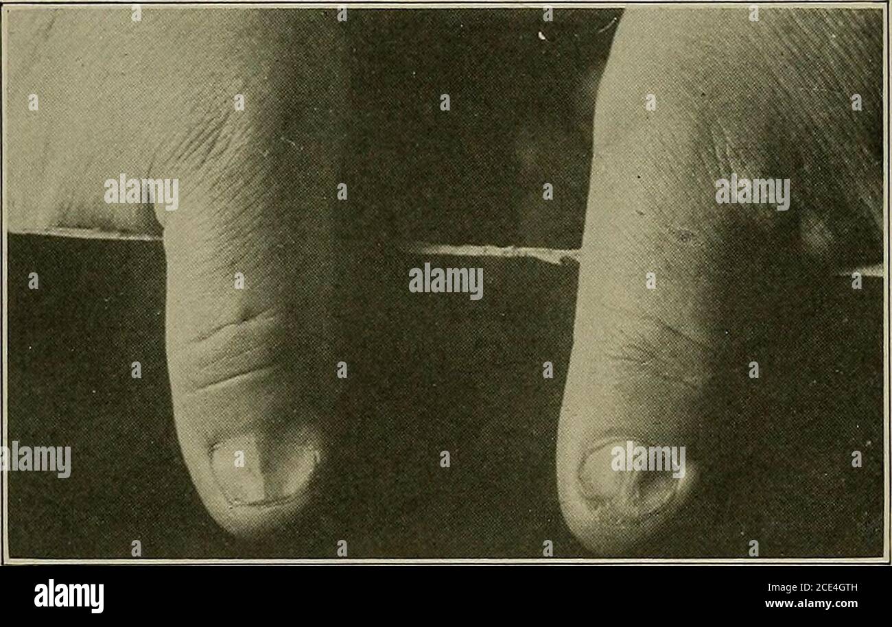 . Syphilis : a treatise on etiology, pathology, diagnosis, prognosis ...