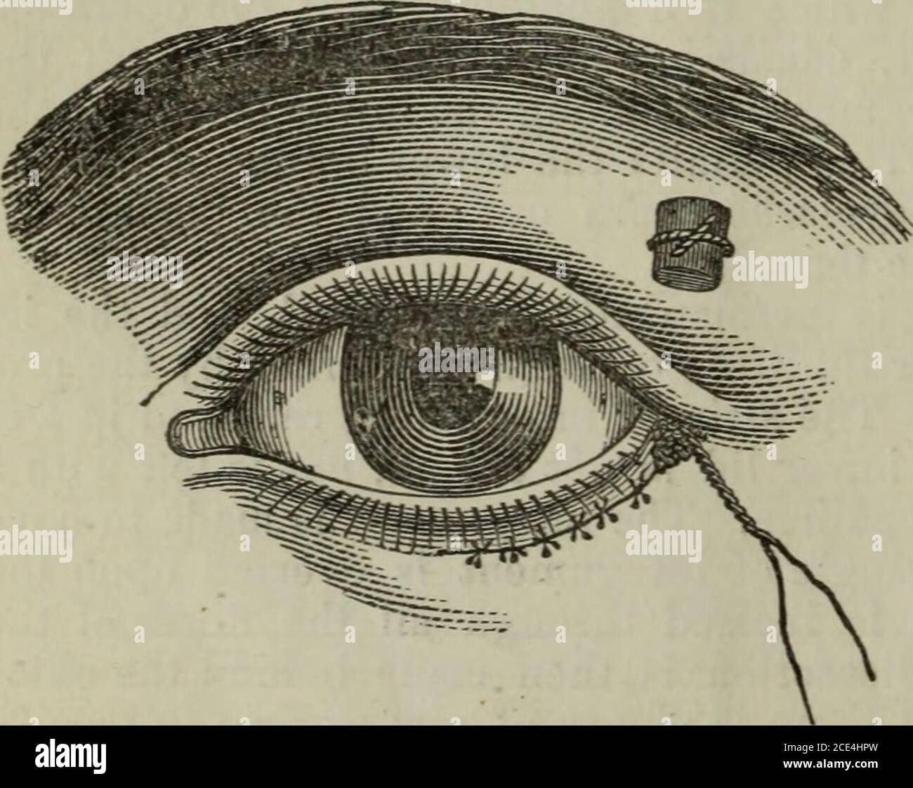 Cornea rough hi-res stock photography and images - Alamy
