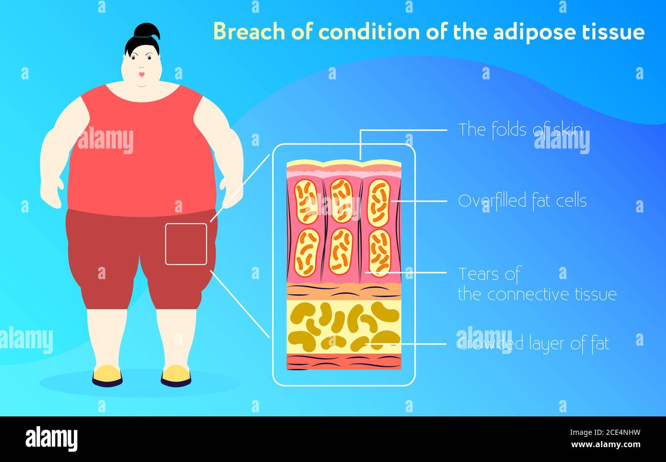 Obesity Medicine poster template in flat design Stock Vector Image ...