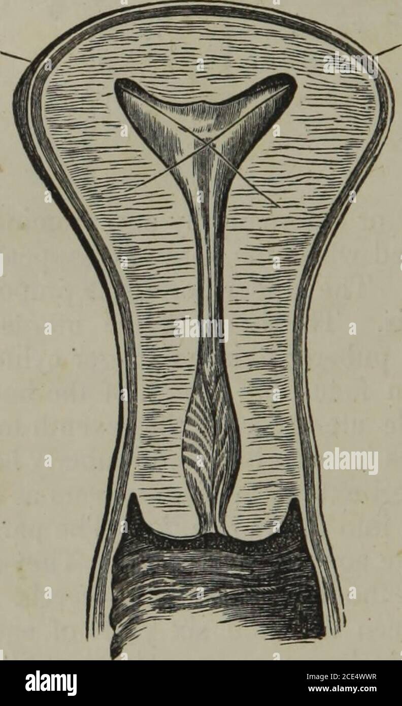 Narrow Os Cervix
