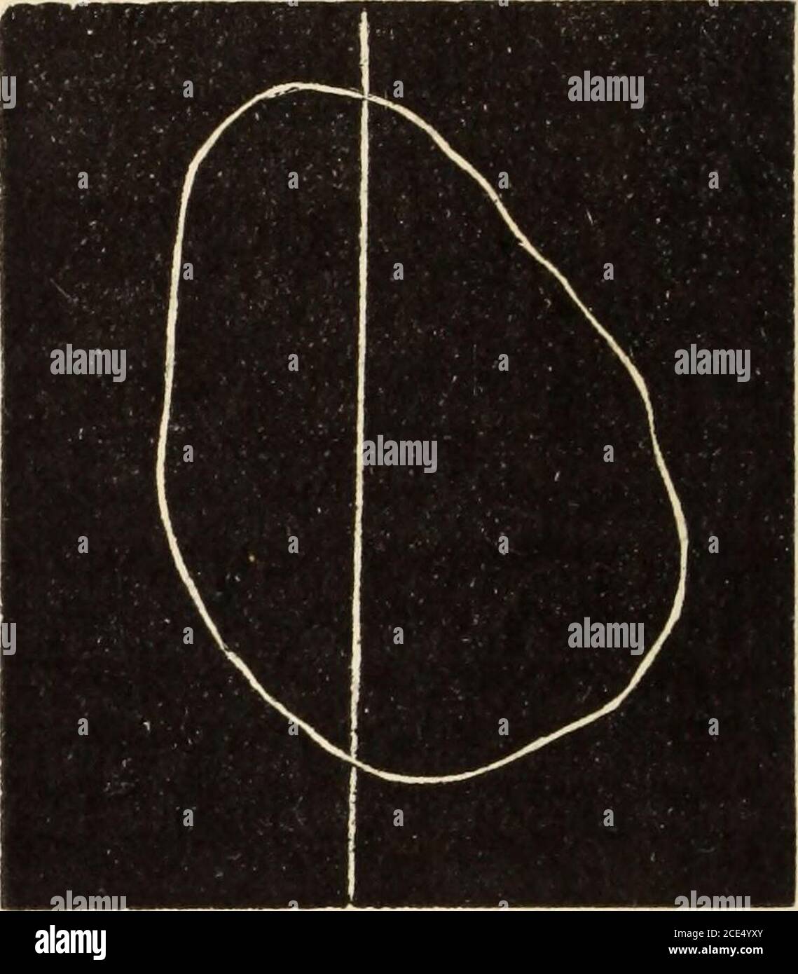 Microcephalic hi-res stock photography and images - Alamy