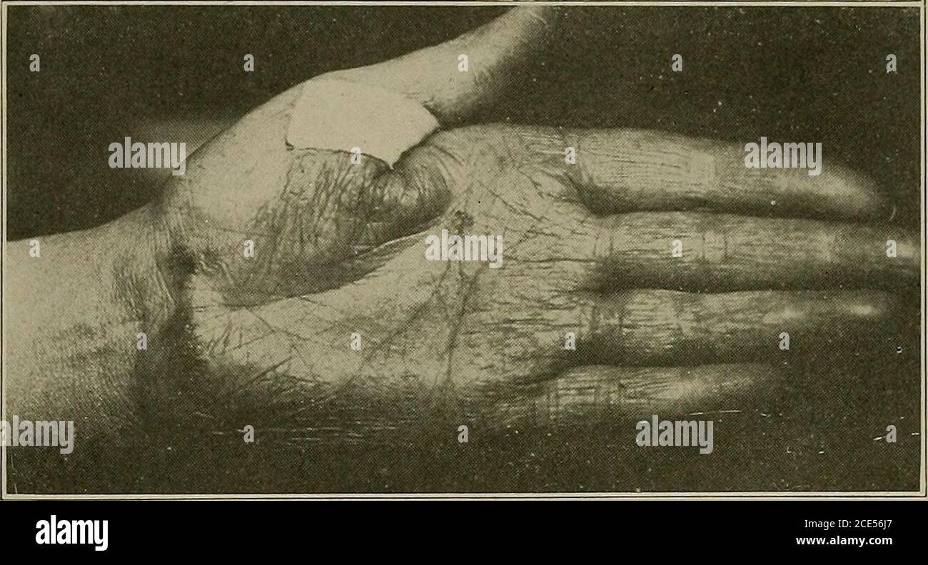 . Syphilis : a treatise on etiology, pathology, diagnosis, prognosis ...