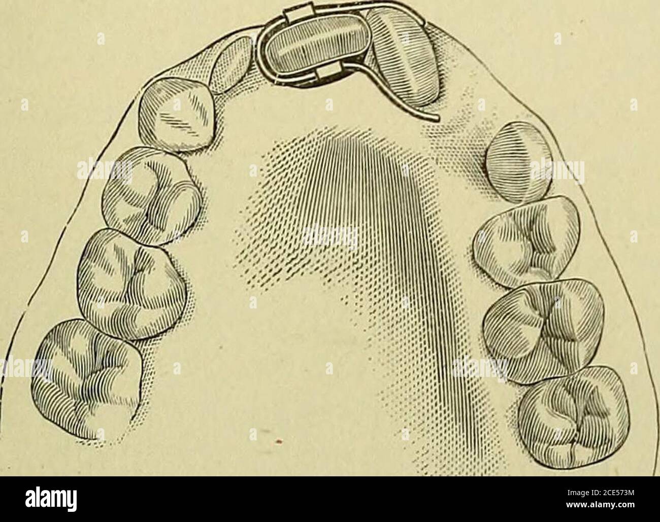 Labial wire hi-res stock photography and images - Alamy