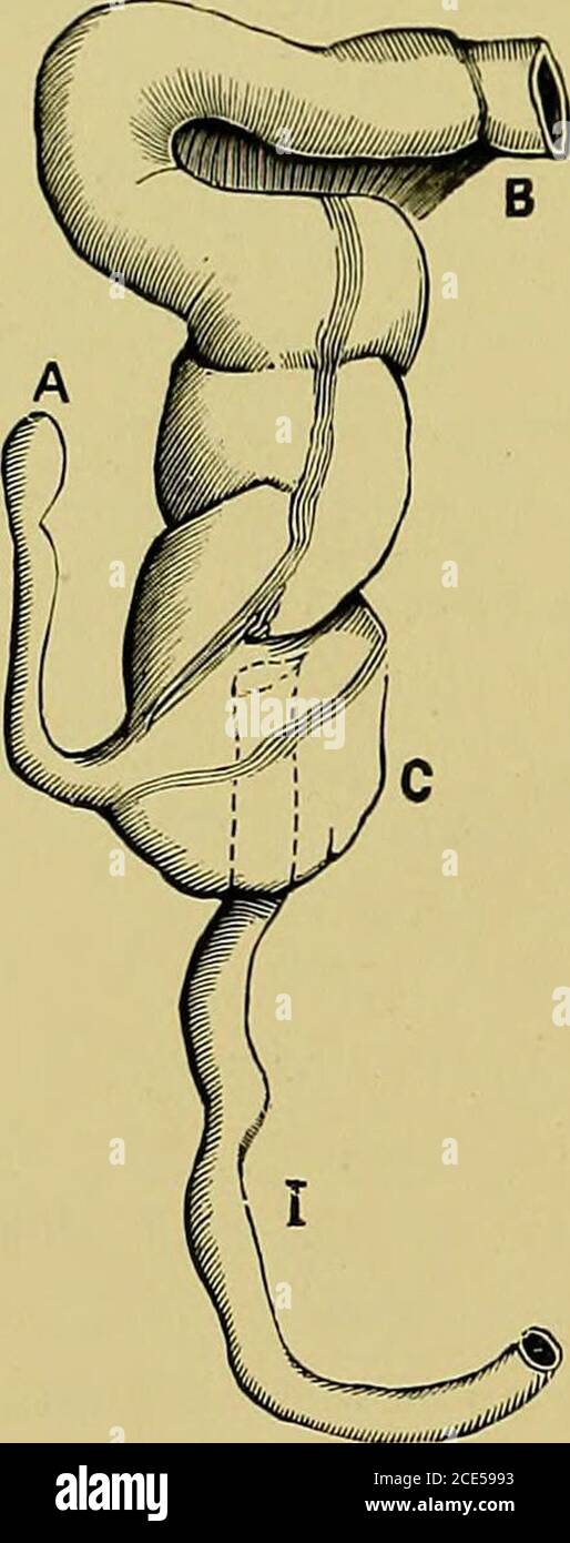 Booksubjectappendicitis hi-res stock photography and images - Alamy