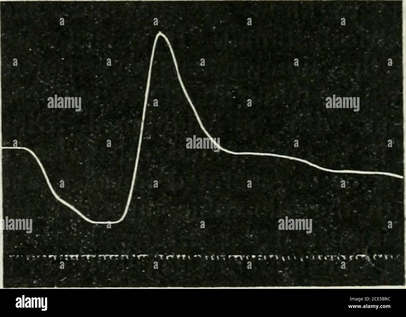 . Dementia praecox and paraphrenia . Fig. 14.Simple Finger Movement in ...
