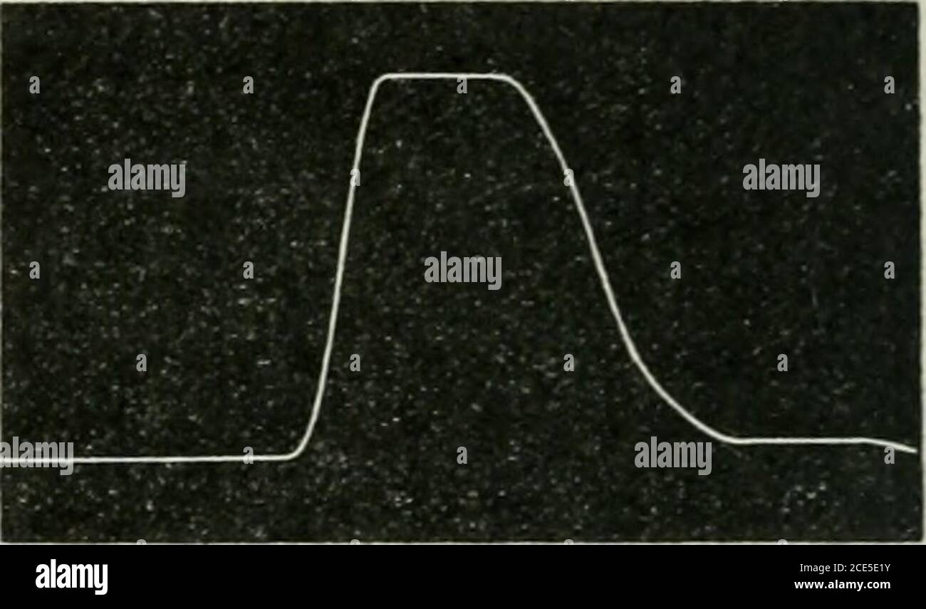 . Dementia praecox and paraphrenia . Fig. 14.Simple Finger Movement in ...