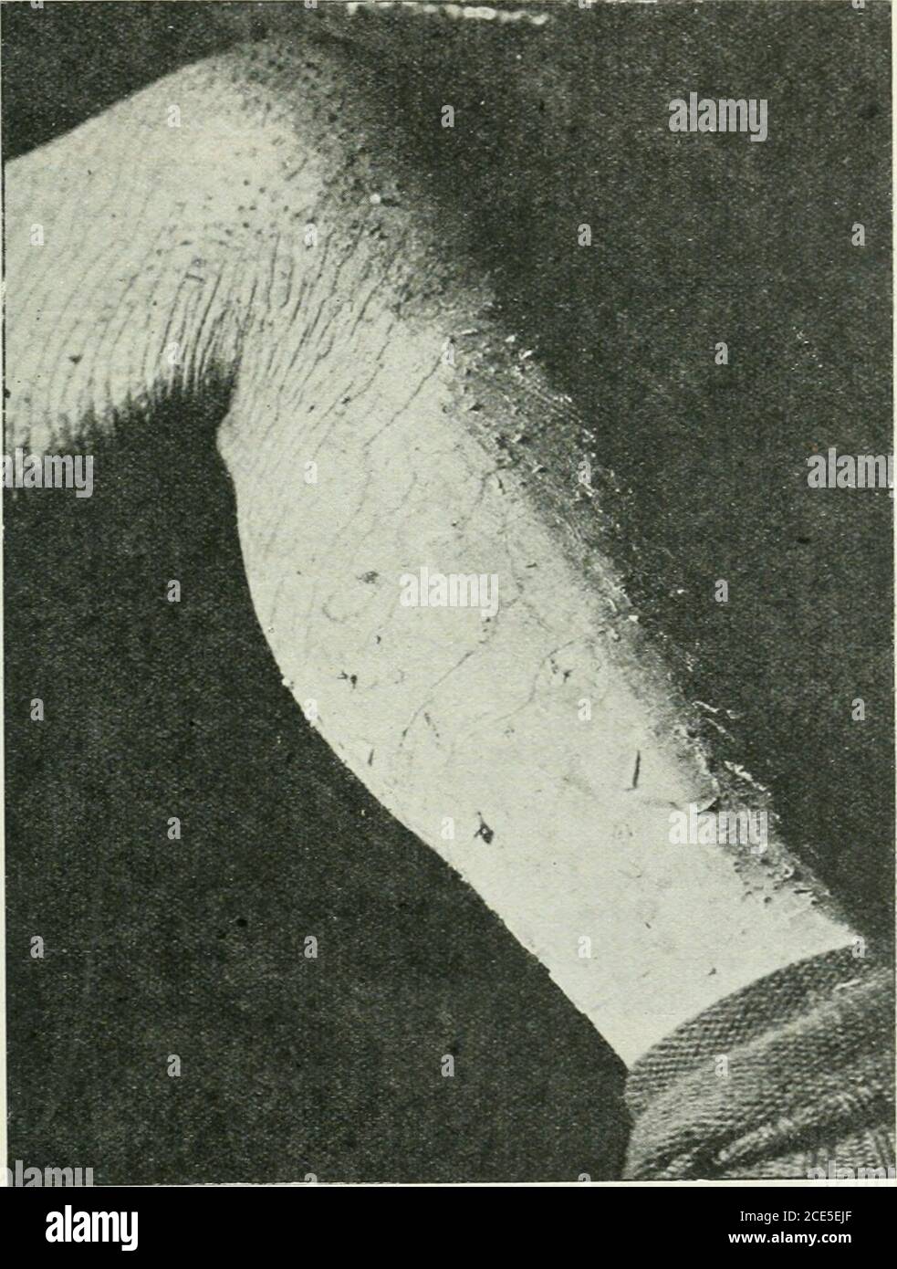 Radiation burn x ray hi-res stock photography and images - Alamy