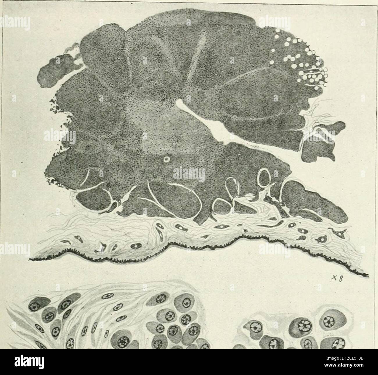 . The British journal of dermatology . hic haimorrhagic sarcoma cases ...