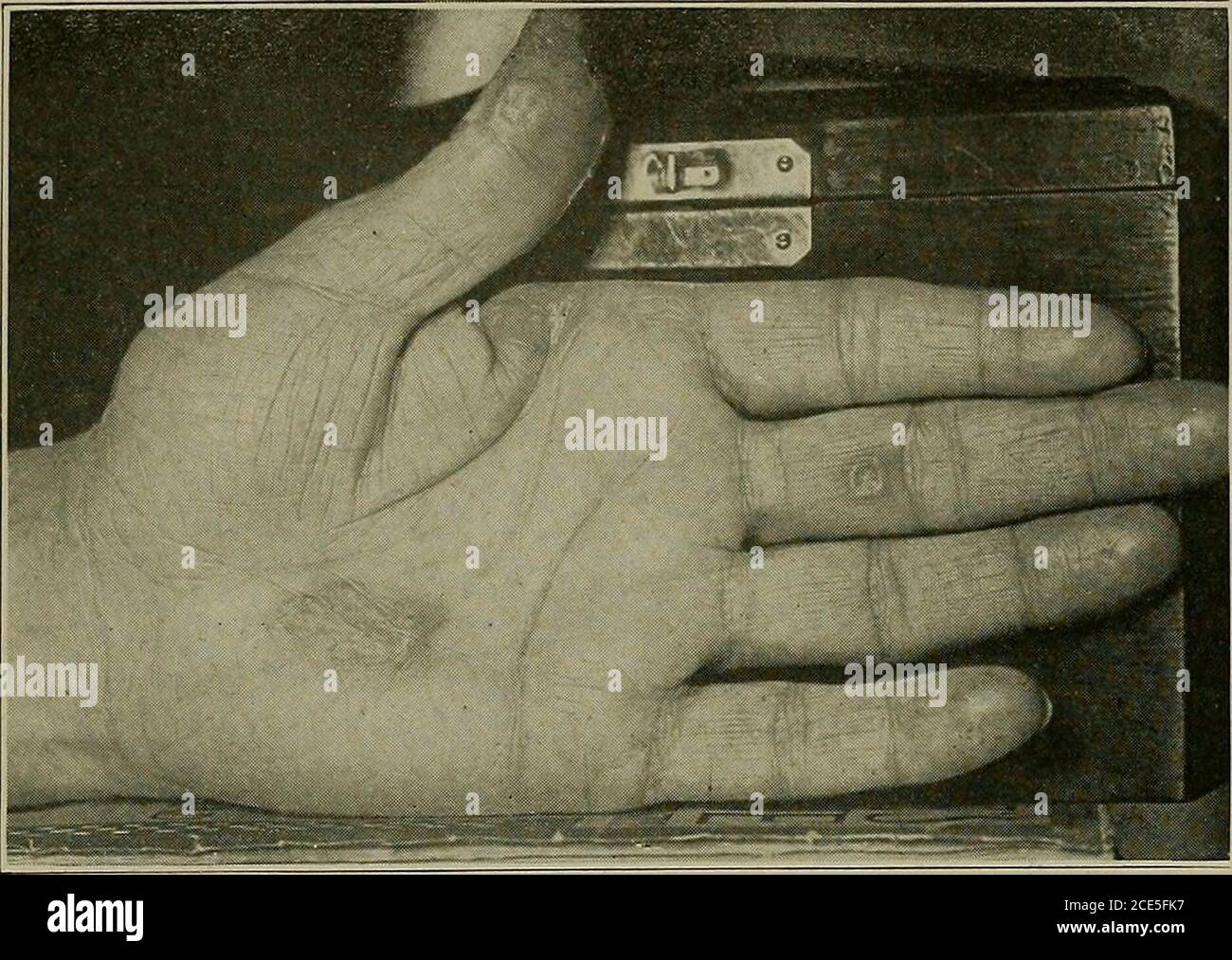 Primary syphilis hi-res stock photography and images - Alamy