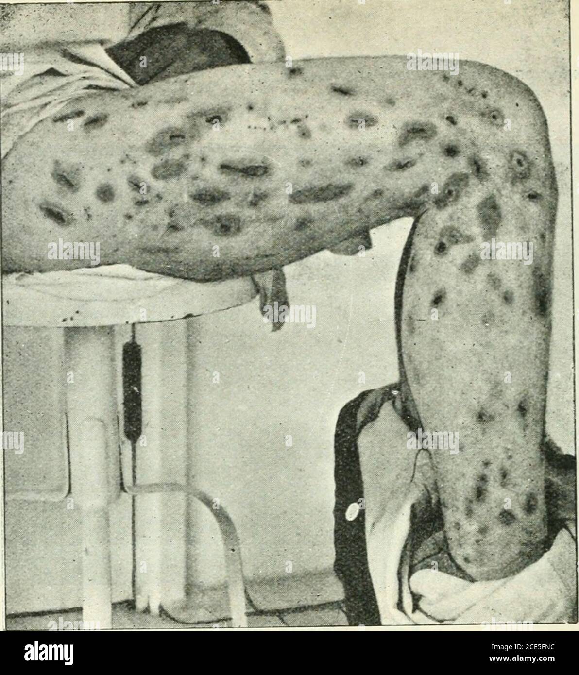 . The British journal of dermatology . Fig. 10.—Linear impetigo—late ...