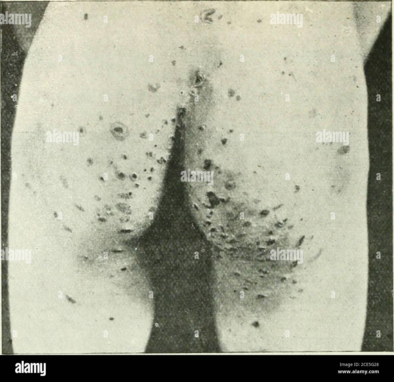 Secondary syphilis hi-res stock photography and images - Alamy