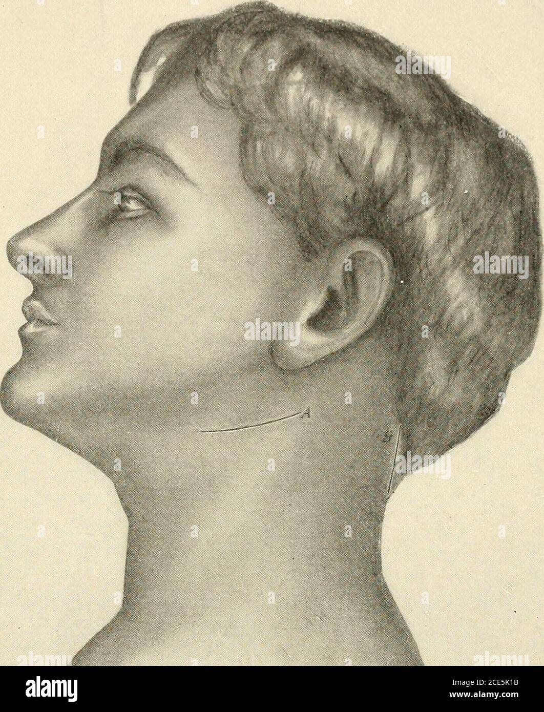 Cervical incision hi-res stock photography and images - Alamy