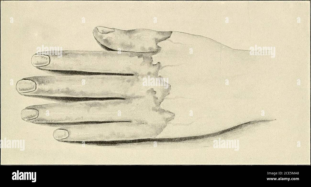 Shoulder ulcers diseases hi-res stock photography and images - Alamy