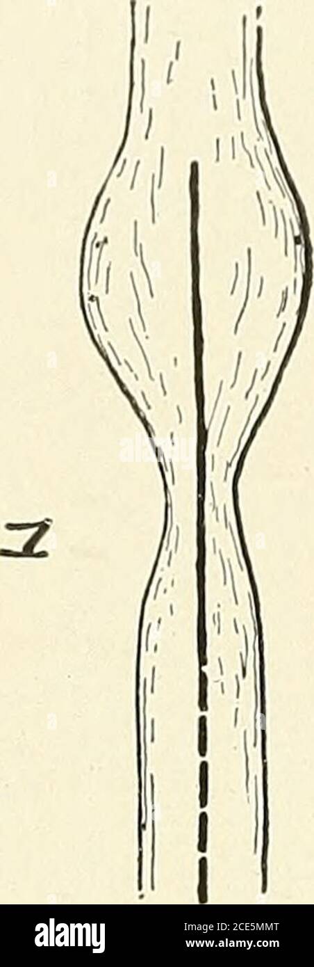 Neurectomy hi-res stock photography and images - Alamy