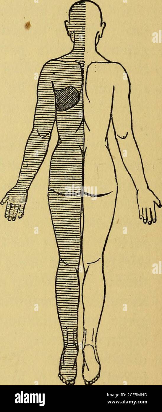 . Hysteria and neurasthenia : . Fig. 3.—Hemiansesthesia of left side ...