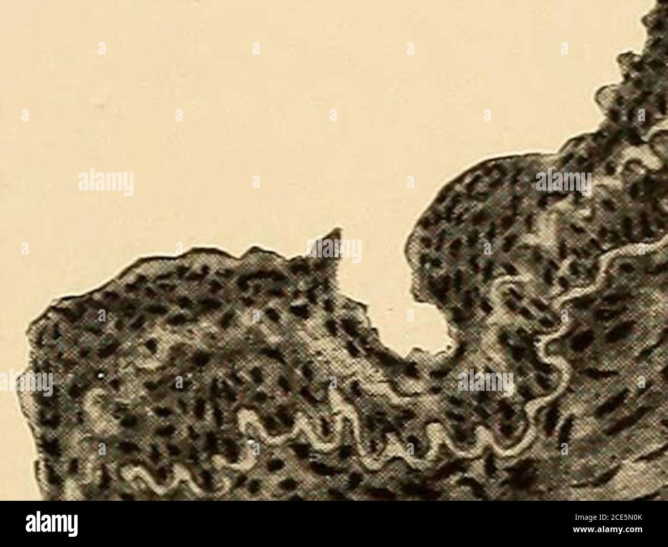 Endarteritis hi-res stock photography and images - Alamy