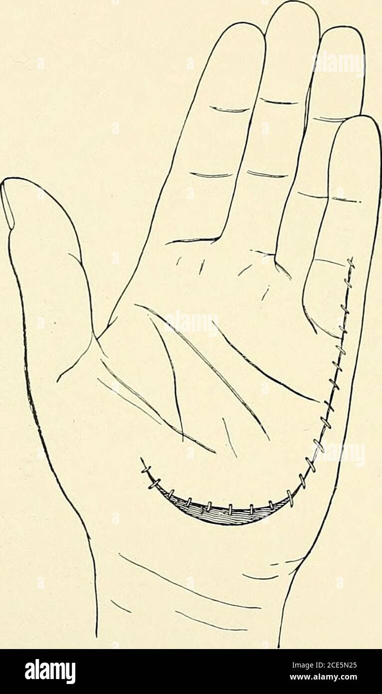 Dupuytren hand hi-res stock photography and images - Alamy