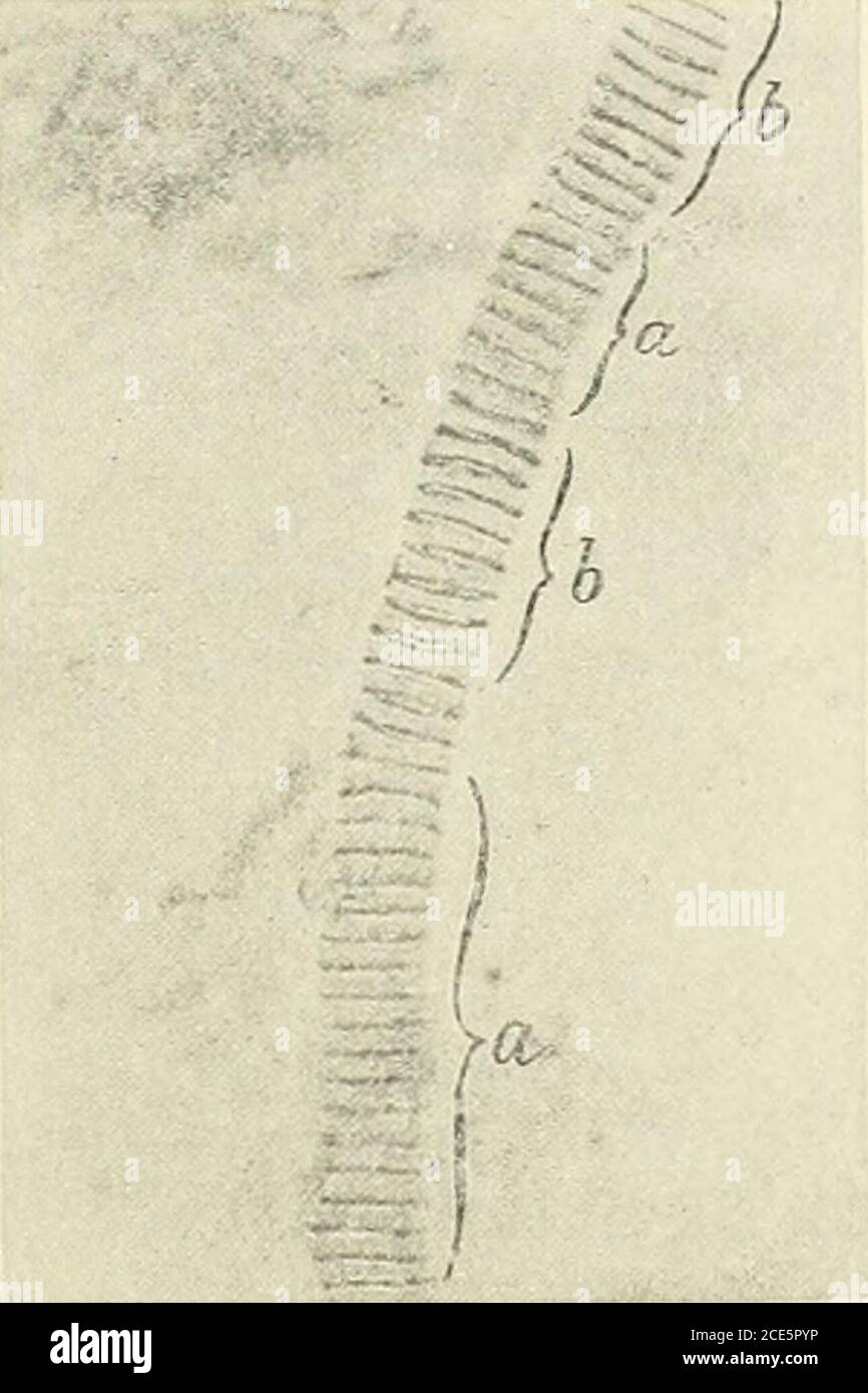 Fused discs hi-res stock photography and images - Alamy