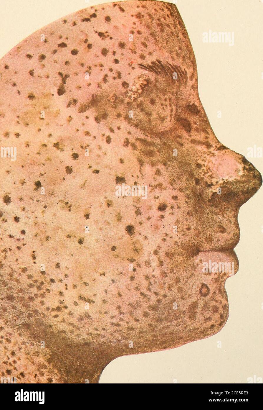 Nasa Xeroderma Pigmentosum