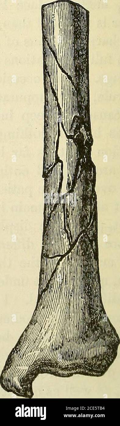 Splinters needle hi-res stock photography and images - Alamy