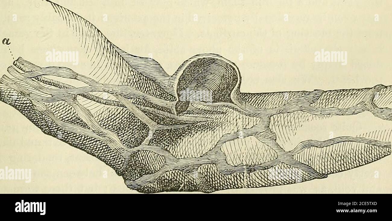 Venesection hi-res stock photography and images - Alamy