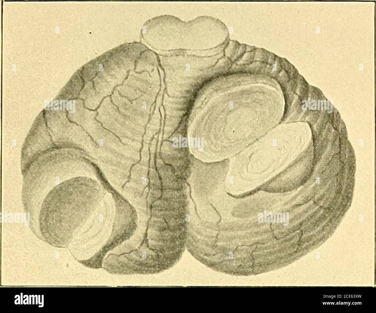 Cerebello pontine angle hi-res stock photography and images - Alamy
