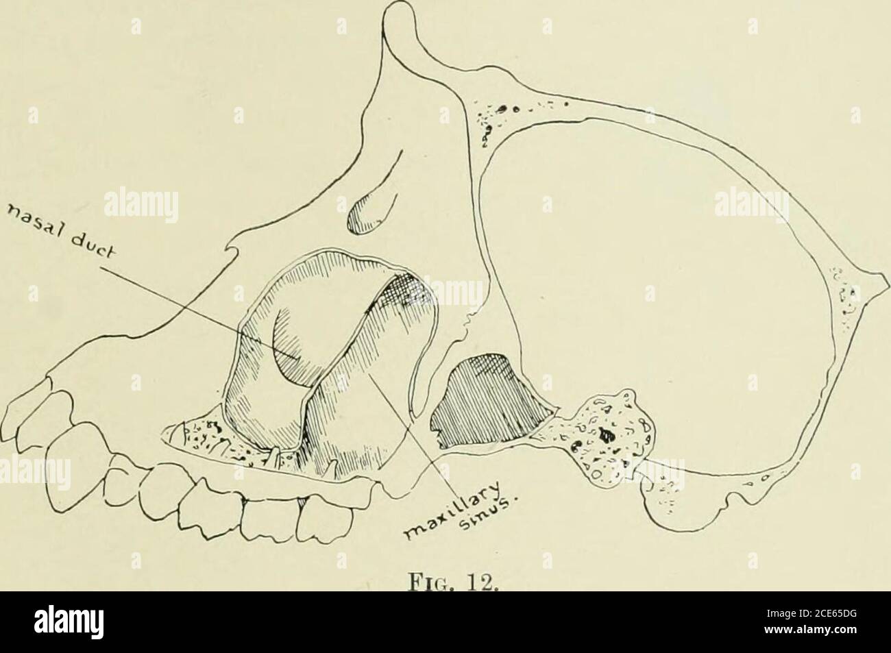 Maxillary Sinus Antrum