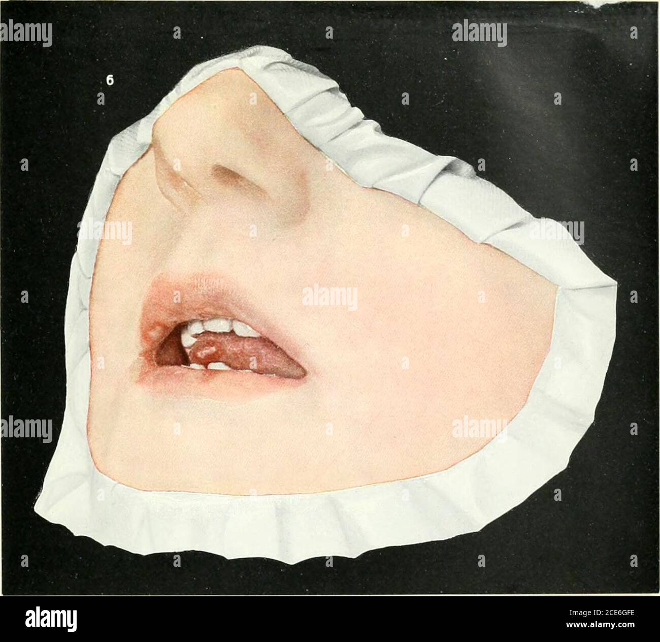 Roseola High Resolution Stock Photography and Images - Alamy