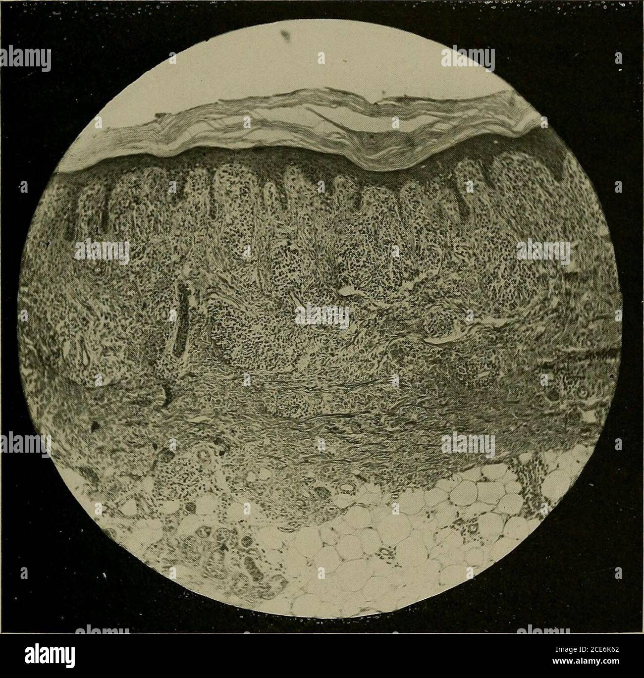 . Syphilis : a treatise on etiology, pathology, diagnosis, prognosis ...