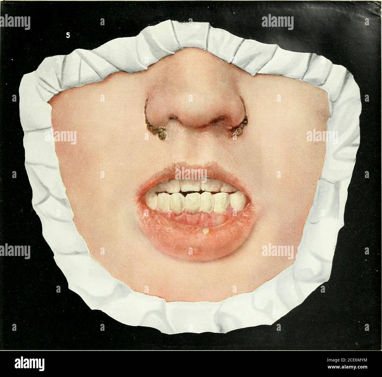 Condylomata hi-res stock photography and images - Alamy