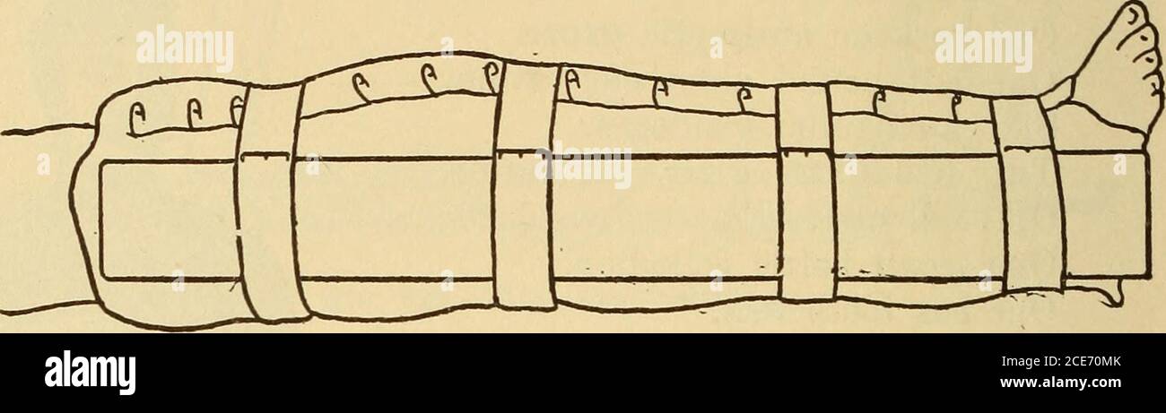 Leg strapping hi-res stock photography and images - Alamy