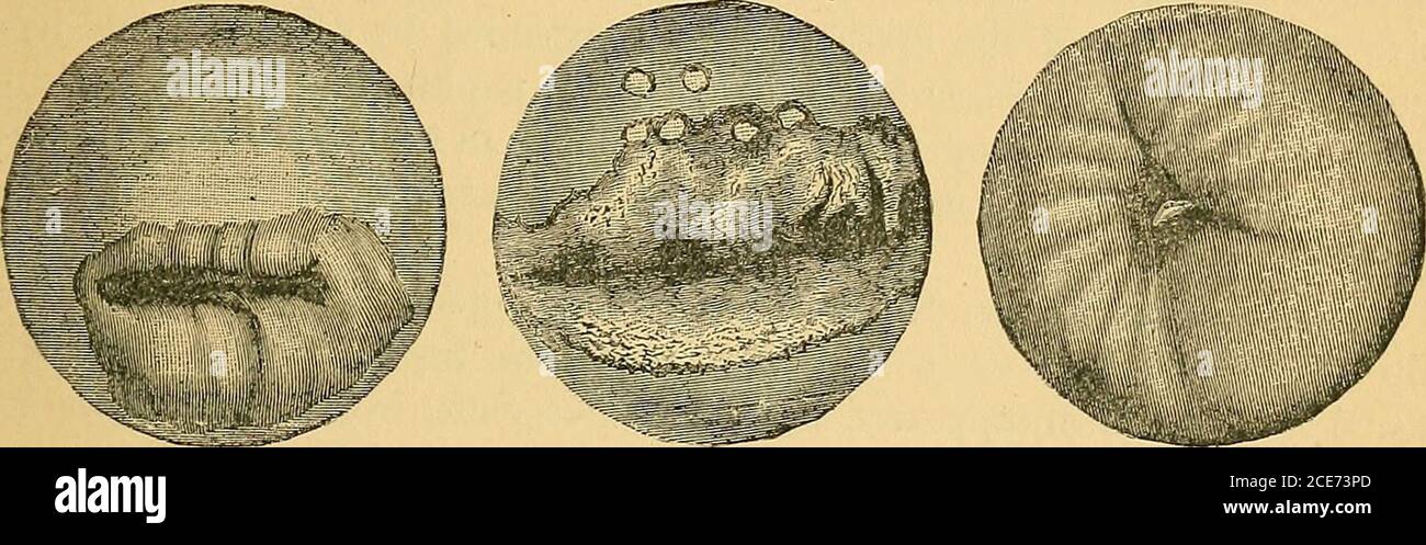 . Cyclopædia of obstetrics and gynecology . FiG. 1.—Cervix of a ...