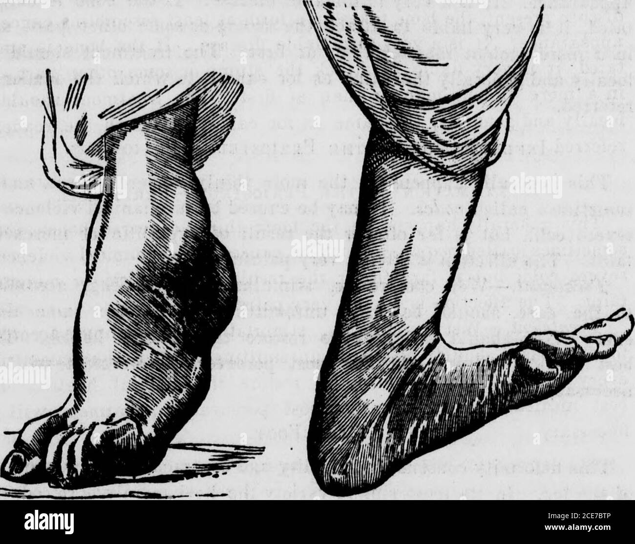 Talipes varus Black and White Stock Photos & Images - Alamy