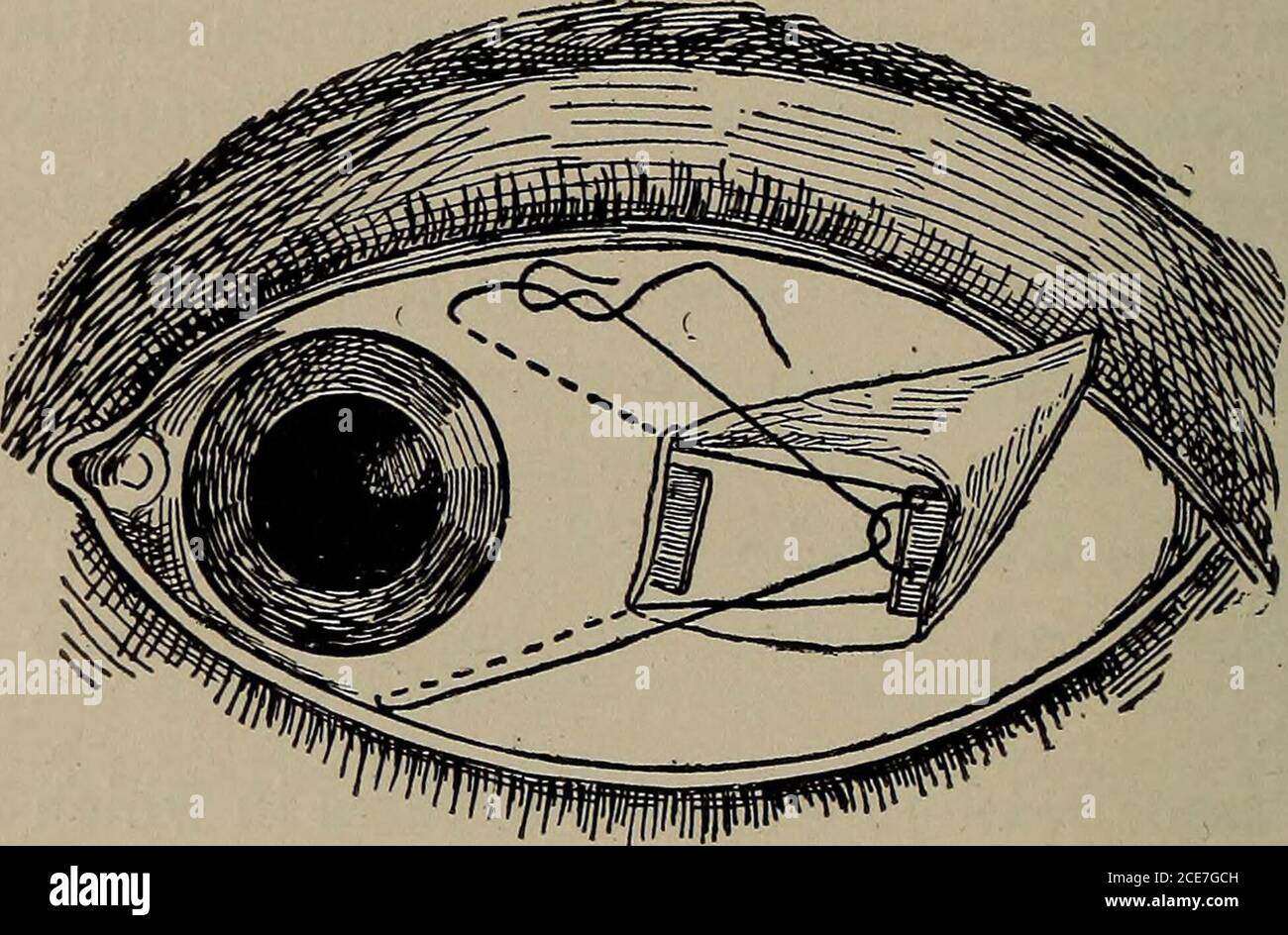 Excised eye hi-res stock photography and images - Alamy