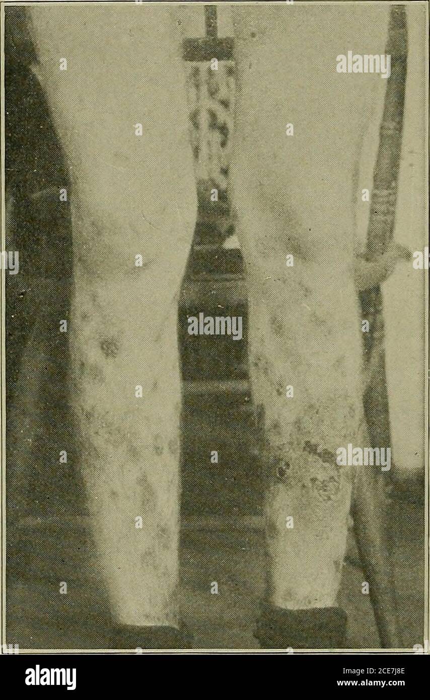 Smallpox skin lesions hi-res stock photography and images - Alamy