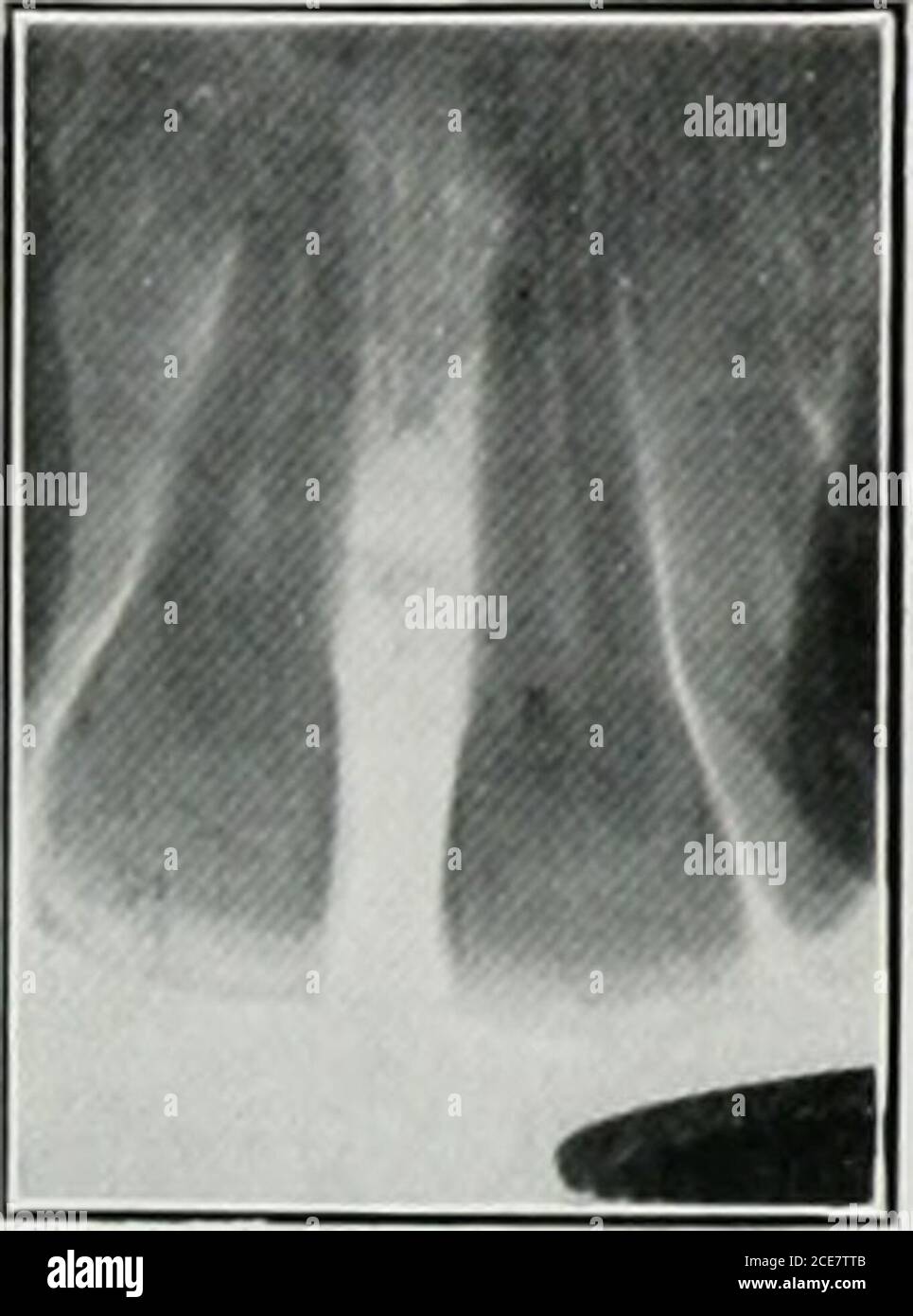 Periodontal pockets hi-res stock photography and images - Alamy