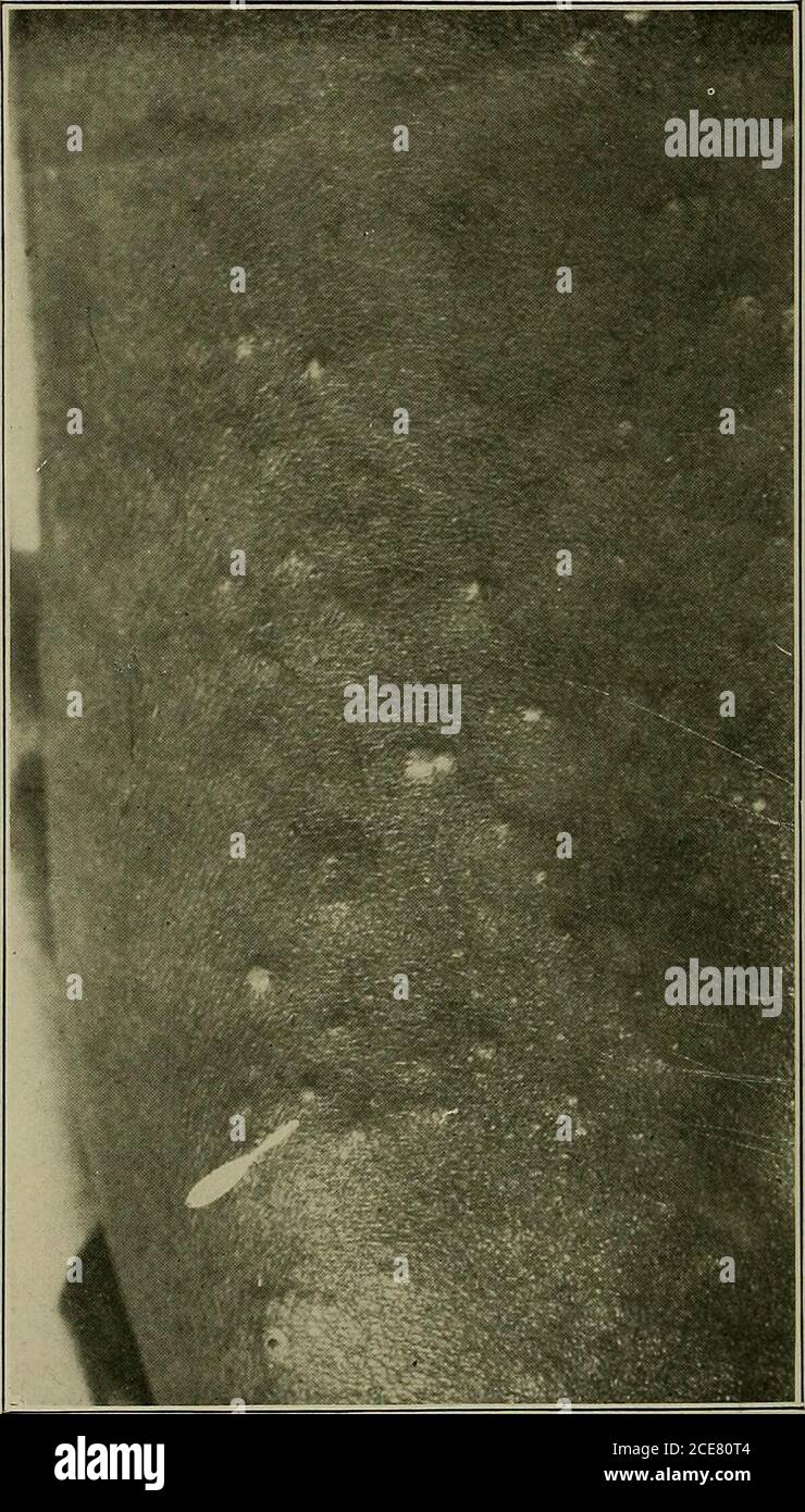 . Syphilis : a treatise on etiology, pathology, diagnosis, prognosis ...