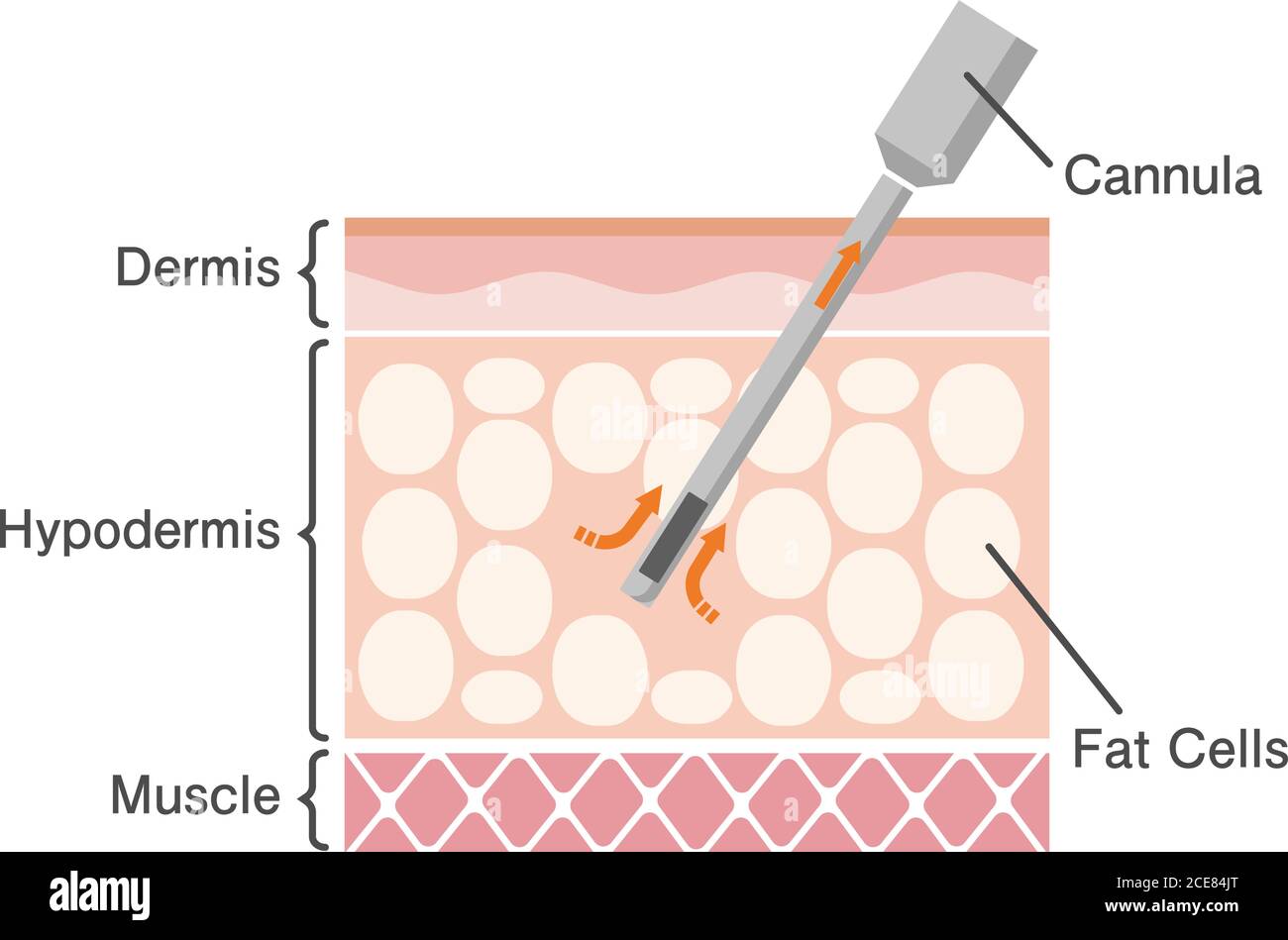 Liposuction process vector illustration / sectional view of skin Stock ...