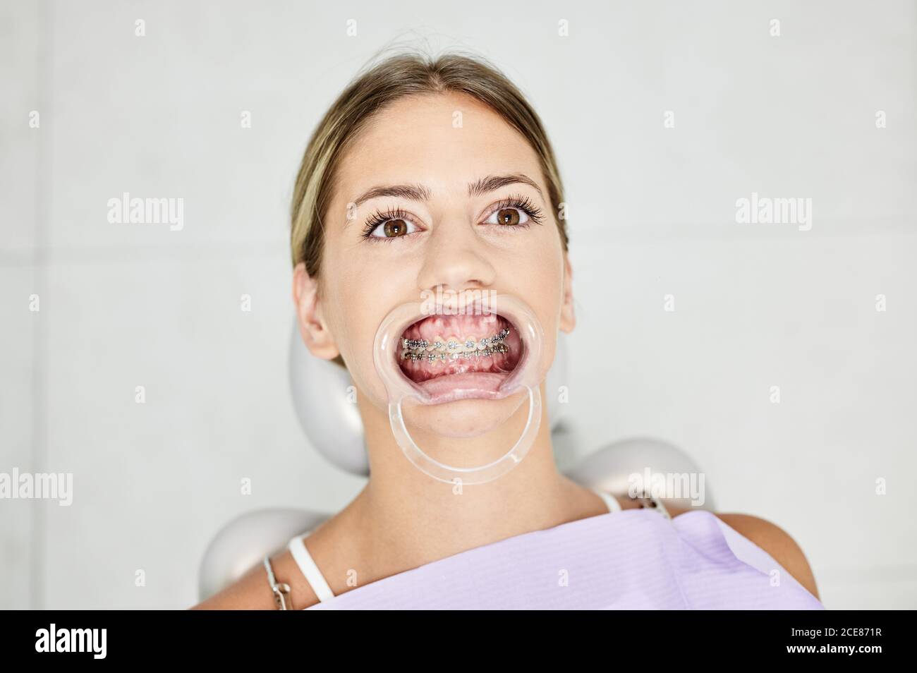 From above of adult Woman with napkin on chest wearing braces and ...