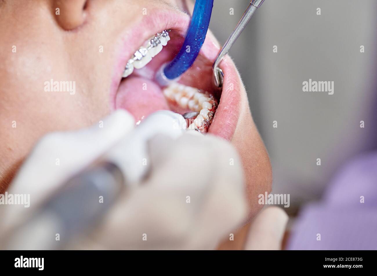 From above of crop faceless patient with braces having cleaning ...