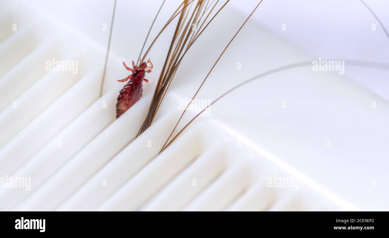 Lice in hair hi-res stock photography and images - Alamy