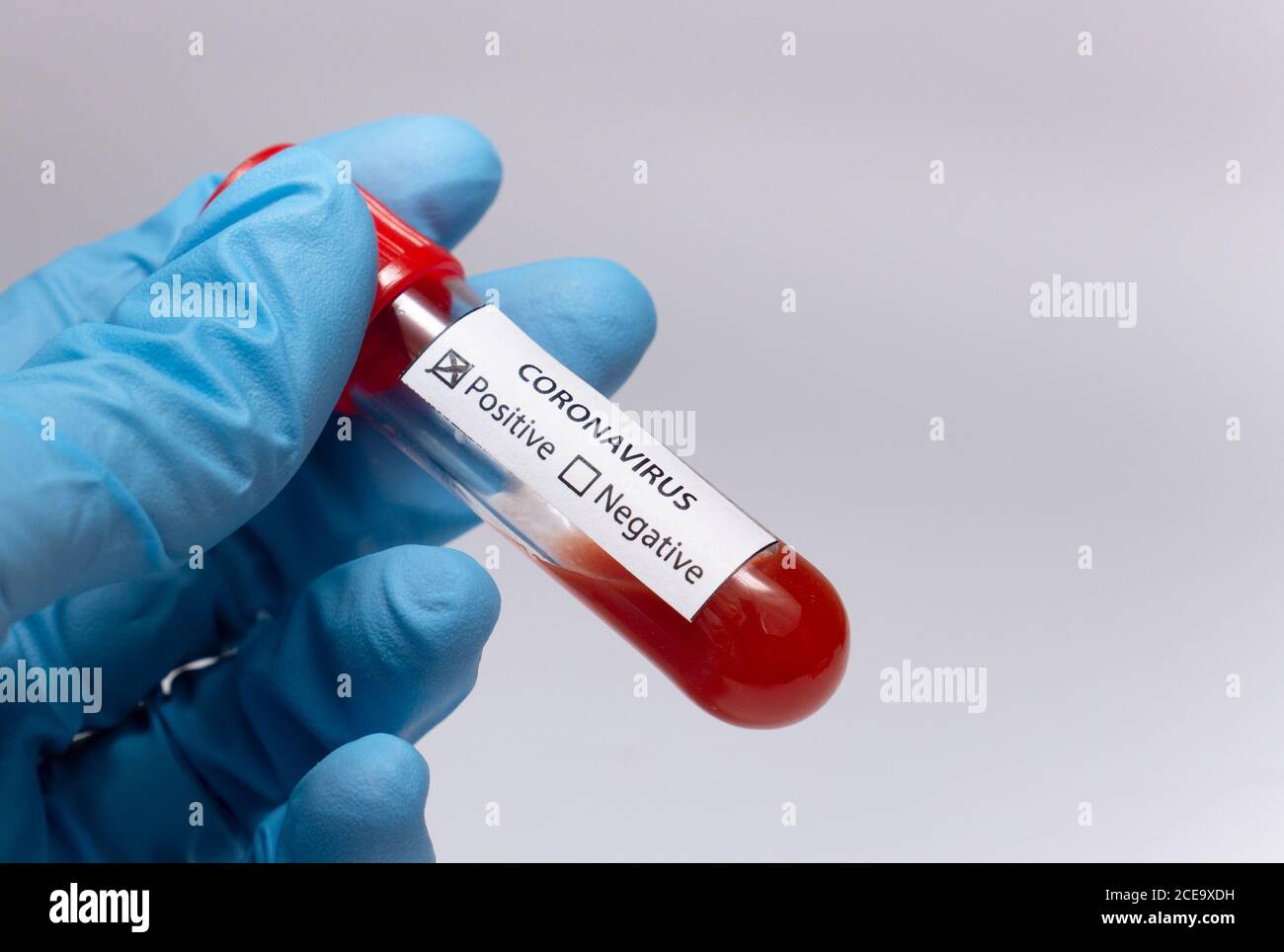 Blood positive test to coronavirus. Medical reseach, test-tube with ...