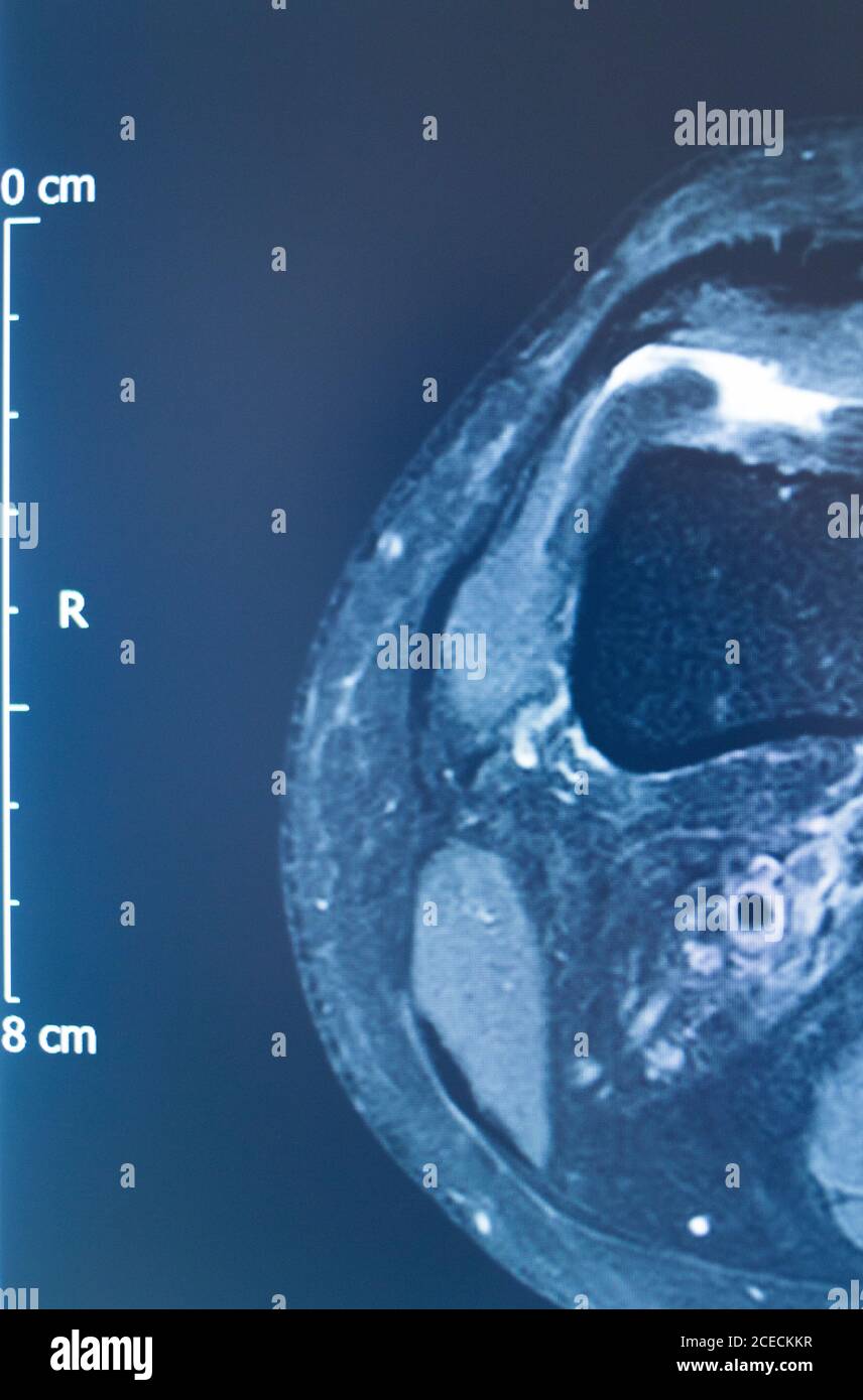 Knee sports injury mri mcl grade 2 tear magnetic resonance imaging ...