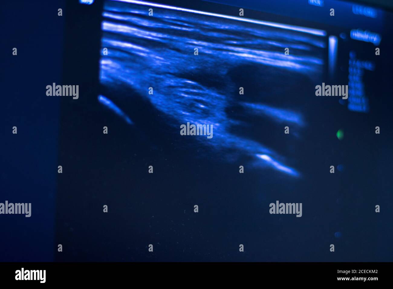 EPI Intratissue Percutaneous Electrolysis dry needling ultrasound ecography scan physiotherapy ...
