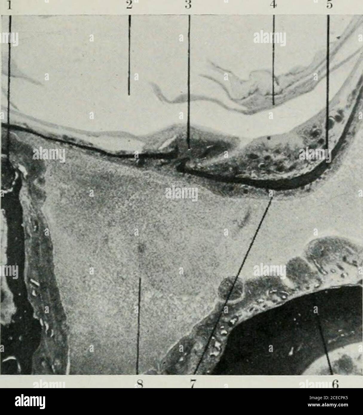 Purulent exudate hi-res stock photography and images - Alamy